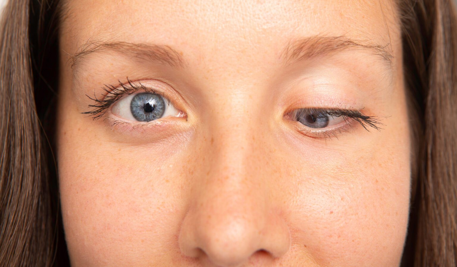 Squint Eye Surgery - Strabismus - Smart Laser Eye Center
