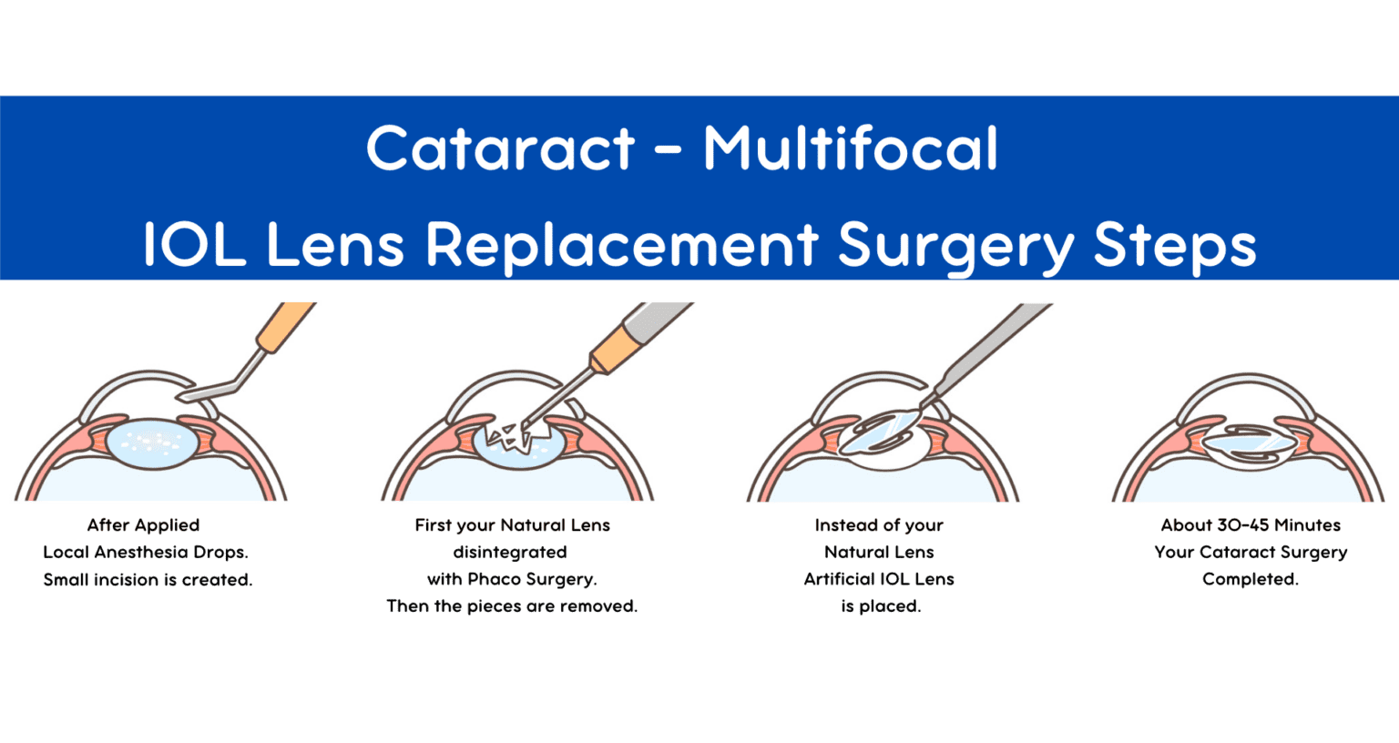 Multifocal Cataract Surgery - Smart Laser Eye Center