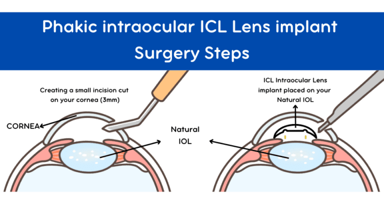 Phakic Lens Surgery - Intraocular ICL Smart Laser Eye Center