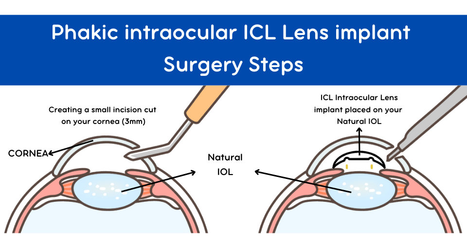 Intraocular Lens Replacement Laser Eye Surgery at Betsy Rivera blog Intraocular Lens Replacement Laser Eye Surgery at Betsy Rivera blog