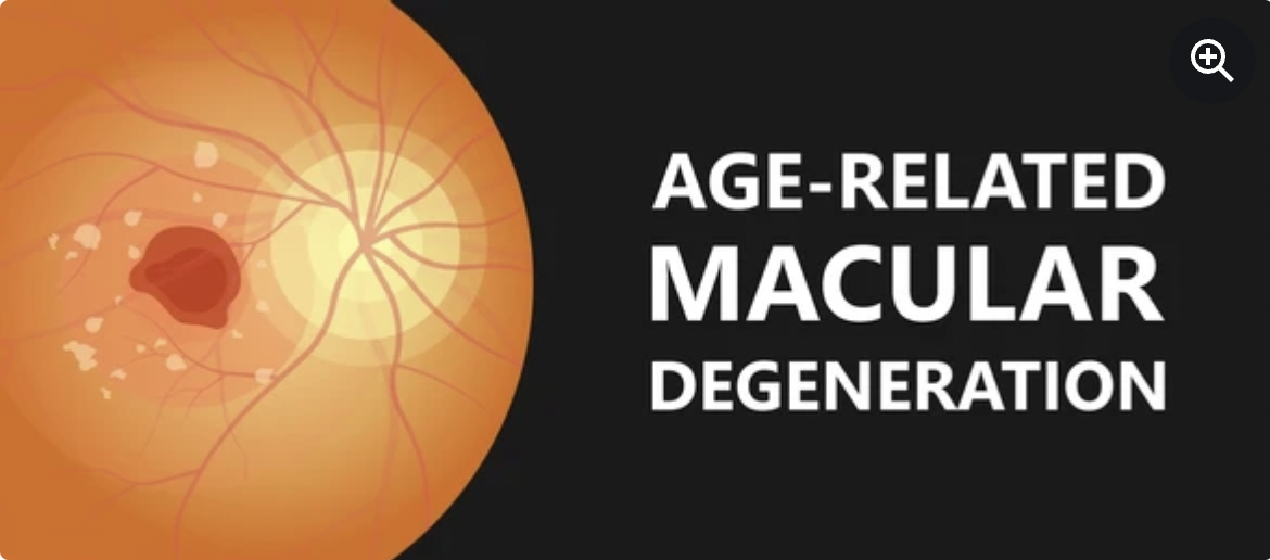 Tratamiento de Degeneración Macular - Smart Laser Eye Center