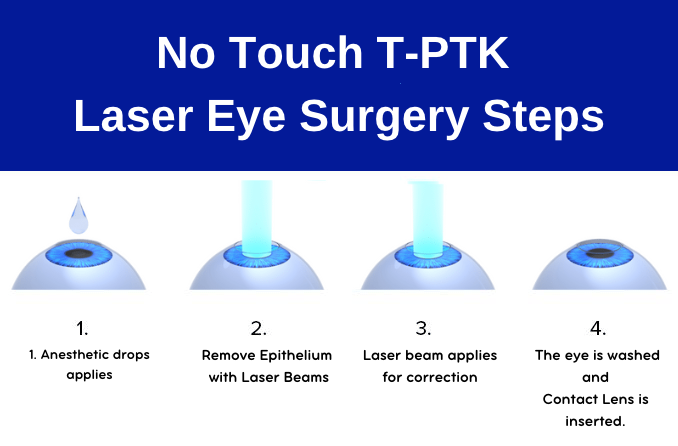No Touch Laser Eye Surgery (T-PRK) Smart Laser Eye Center