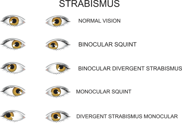 Squint Eye Surgery - Strabismus - Smart Laser Eye Center